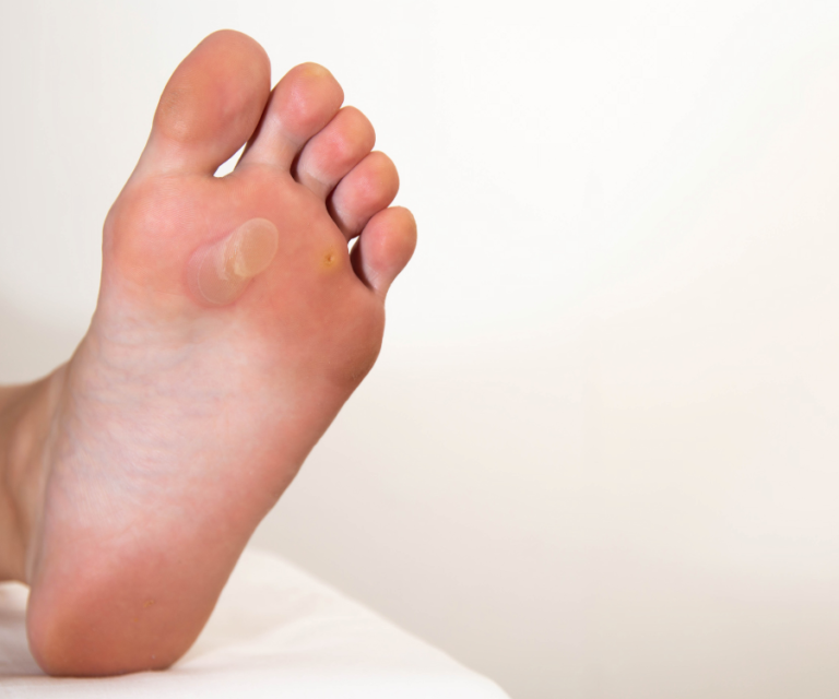 When to See a Podiatrist for Foot Calluses – Khan Podiatry